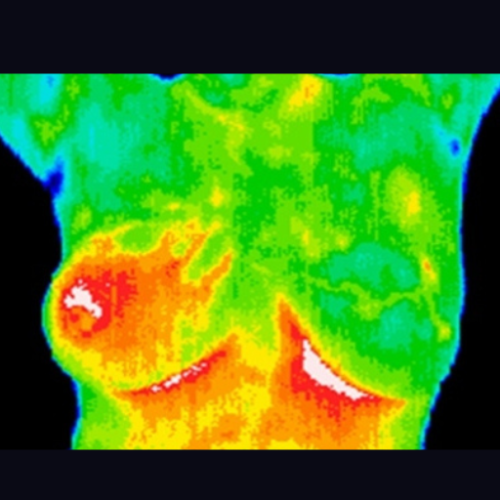 Breast Cancer Screening: Consider Adding Thermography to Your Annual ...