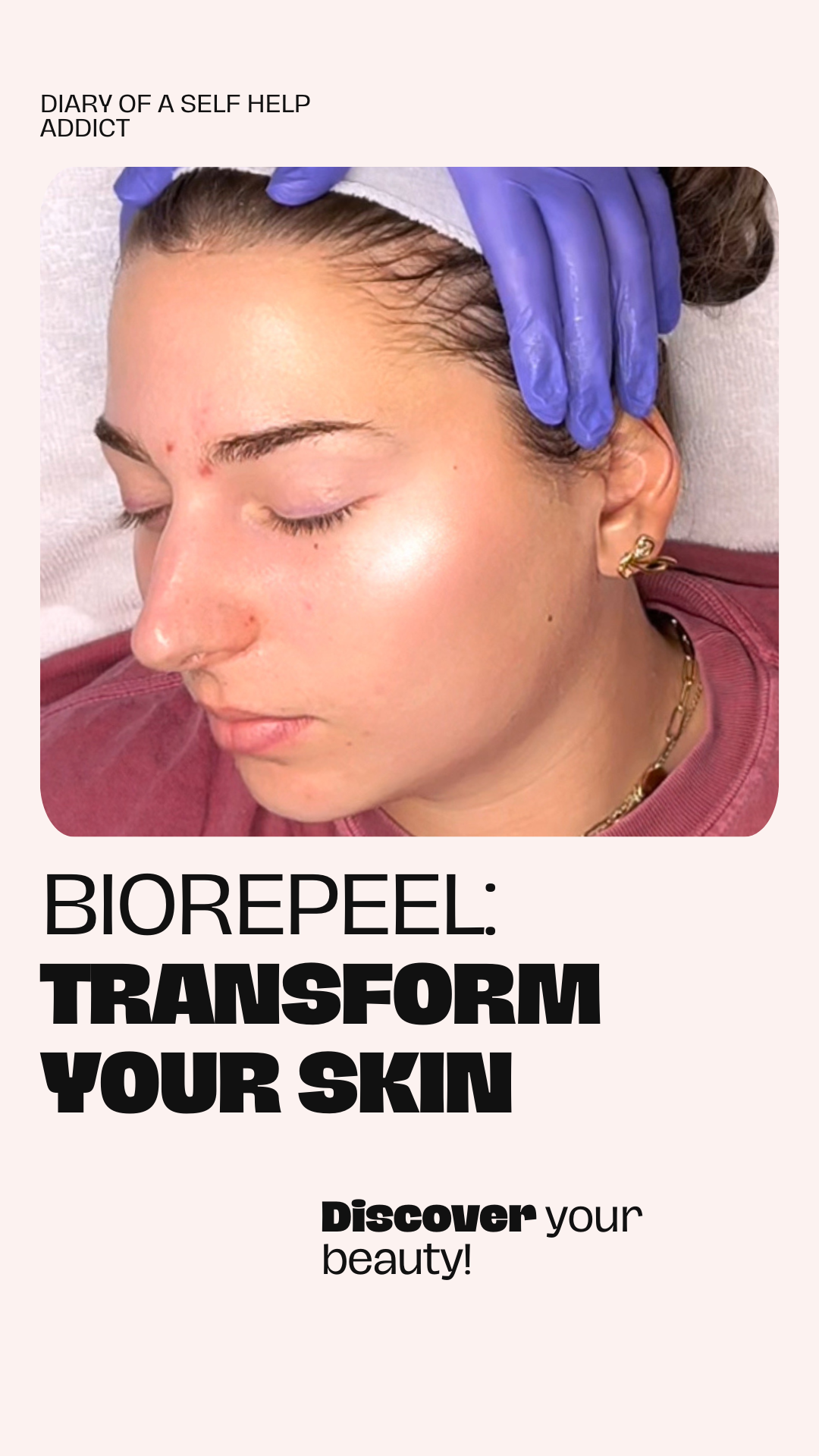 BioRePeel: The Revolutionary Chemical Peel That Works Wonders - Diary ...